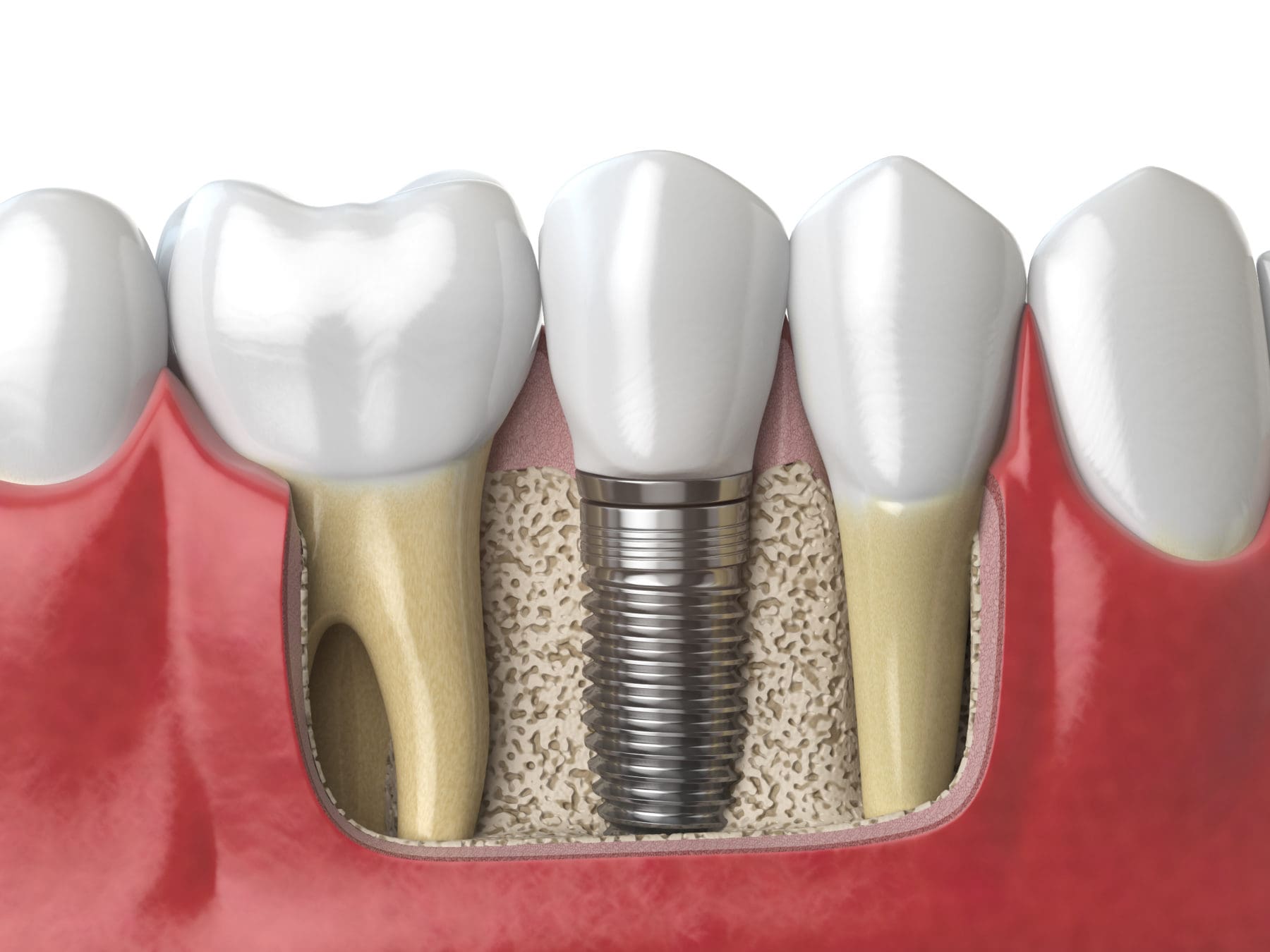 The Dental Implant Process Mt. Pleasant MI | Teeth Implants